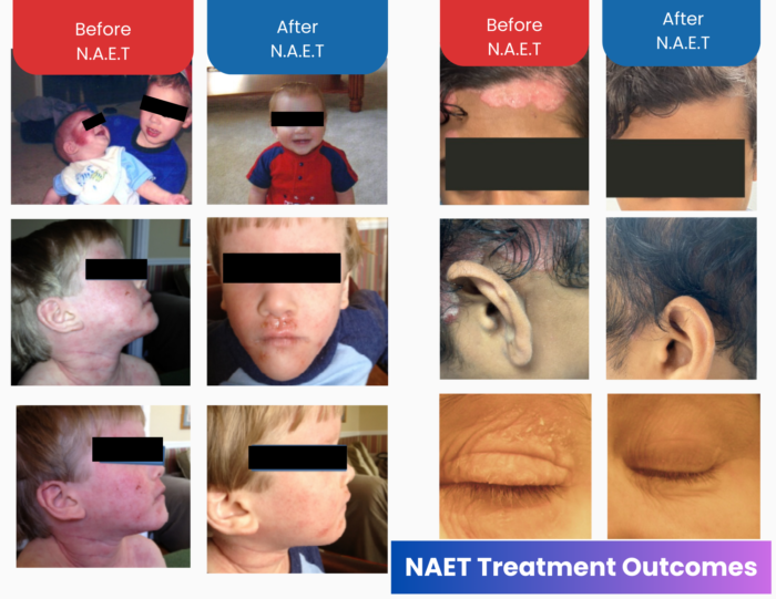 NAET Accelerated Treatment Program | The NAET Clinic